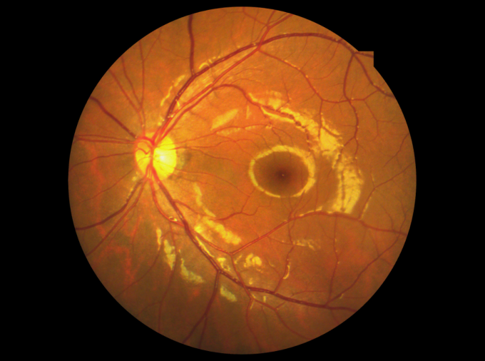 Automatic Ophthalmic Retinal Fundus Camera Equipments