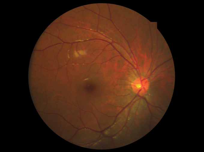 Autofocus Non Mydriatic Fundus Camera System For Cataracts Check