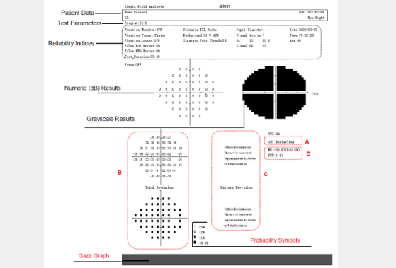 Perimeter Ophthalmic Perimetry Test Instrument 200ms Impact Body ...