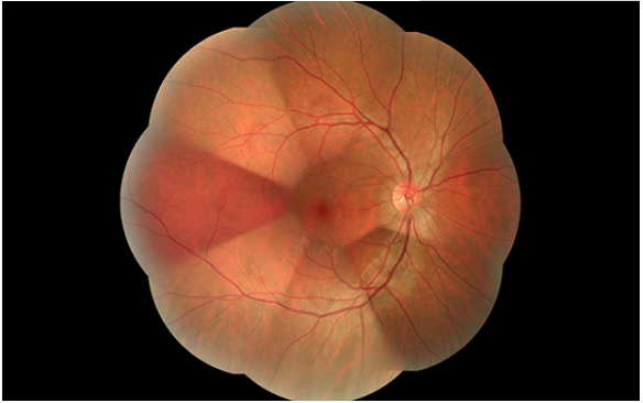 Retinal Imaging HD Fundus Images Camera Equipment 13mm Dual System