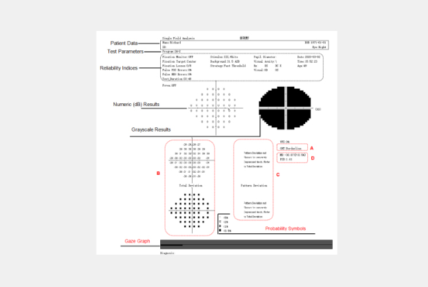 Static Automated Perimetry Machine With Abundant Inspection Modes