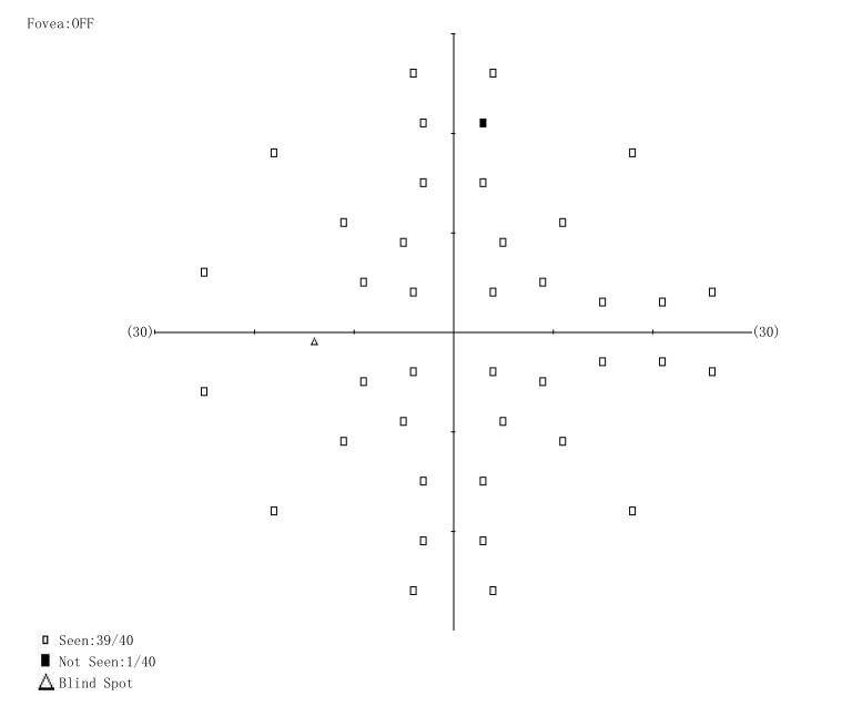 Hospital Automated Perimetry Machine , Computer Peripheral Vision Test ...