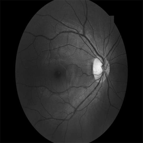 FAF Non Mydriatic Fundus Camera Optical Retinal Imaging