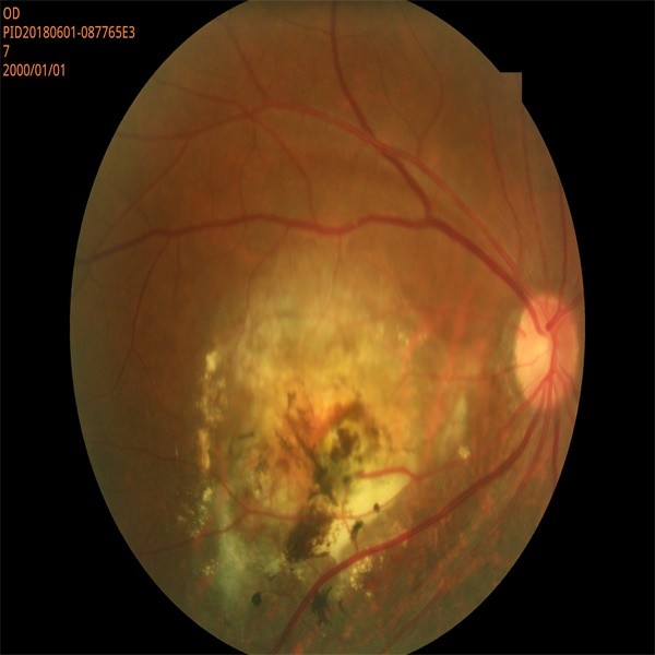 4mm Non Mydriatic Retinal Camera FFA Cataract Disease Imaging