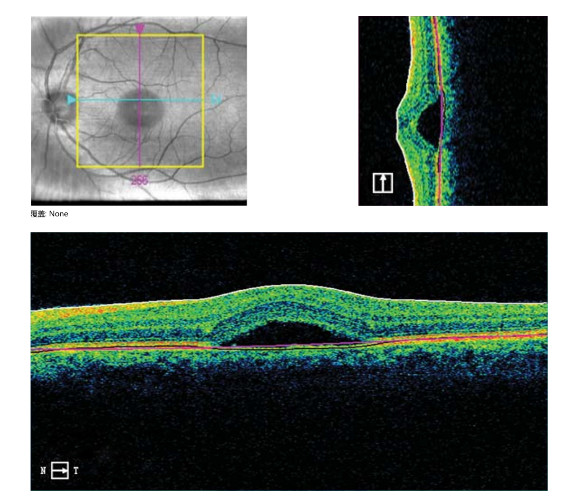 Macular Disease Optical Coherence Tomography System PC Inside